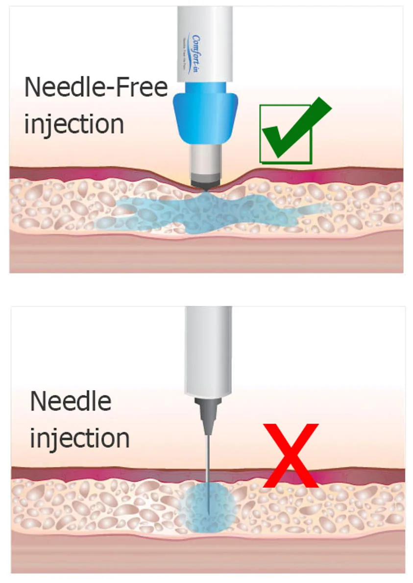 Needle-less Hair Transplant in London, UK - FKS Clinic