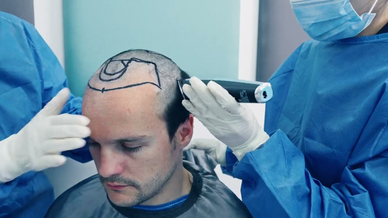 DHI Hair Transplant in London, UK - FKS Clinic